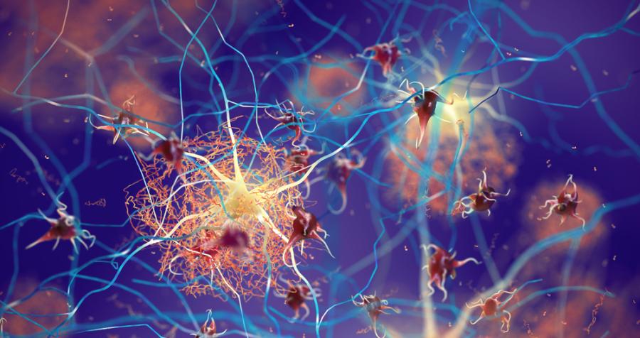 Stem Cell Therapy for Alzheimers disease | Stemaid Institute